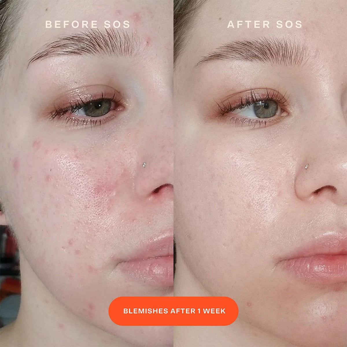 SOS Intensive Redness Relief Serum with Hypochlorous Acid (Suero Facia ...